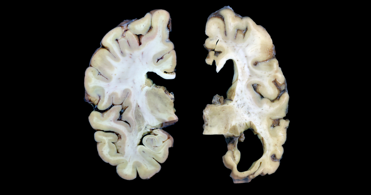 FDA approves new Alzheimer’s disease drug